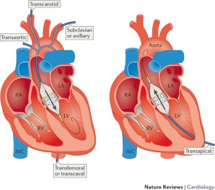 Matching patients with the ever-expanding range of TAVI devices ...