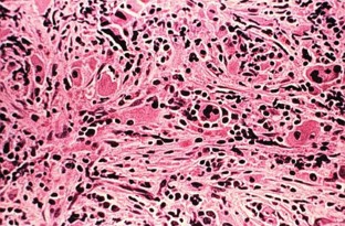 Myeloproliferative neoplasms: contemporary diagnosis using histology ...