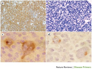 Post-transplant lymphoproliferative disorders | Nature Reviews Disease ...