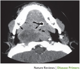 Post-transplant lymphoproliferative disorders | Nature Reviews Disease ...