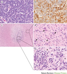 Neuroblastoma | Nature Reviews Disease Primers