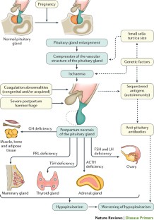 Sheehan syndrome | Nature Reviews Disease Primers