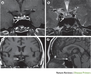 Sheehan syndrome | Nature Reviews Disease Primers