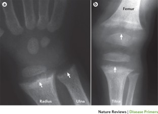 Rickets | Nature Reviews Disease Primers