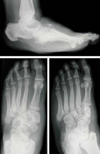 A case of diabetic Charcot arthropathy of the foot and ankle | Nature ...