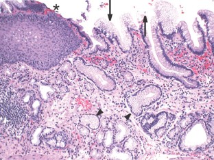 Barrett esophagus: histology and pathology for the clinician | Nature ...