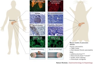 Neural plasticity in pancreatitis and pancreatic cancer | Nature ...