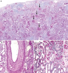 The pathogenesis and treatment of chronic allograft nephropathy ...
