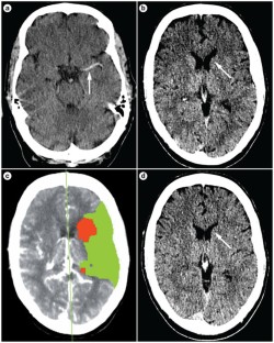 Neurothrombectomy in the treatment of acute ischaemic stroke | Nature ...