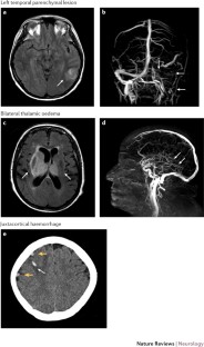 Cerebral venous thrombosis | Nature Reviews Neurology