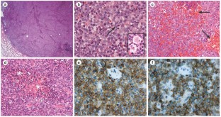 Rapidly fatal HTLV-1-associated T-cell leukemia/lymphoma in a patient ...
