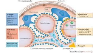What is damaging the kidney in lupus nephritis? | Nature Reviews ...