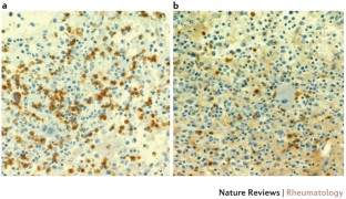 Macrophage activation syndrome in the era of biologic therapy | Nature ...