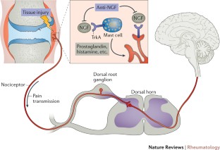 Anti-NGF treatments for pain — two steps forward, one step back ...