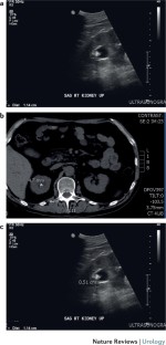 An overview of kidney stone imaging techniques | Nature Reviews Urology