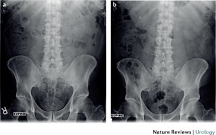 An overview of kidney stone imaging techniques | Nature Reviews Urology