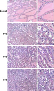 Normal vs cancer thyroid stem cells: the road to transformation | Oncogene