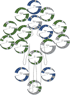A distinct neurodevelopmental syndrome with intellectual disability ...