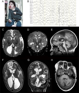 A de novo variant in RAC3 causes severe global developmental delay and ...