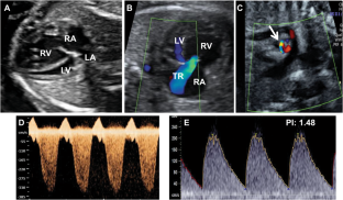 In-utero idiopathic ductal constriction: a prenatal manifestation of ...
