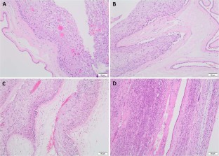Histological chorioamnionitis at term according to labor onset: a ...
