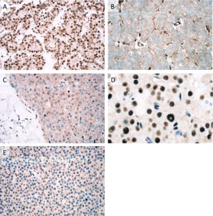 Parafibromin immunostainings of parathyroid tumors in clinical routine ...