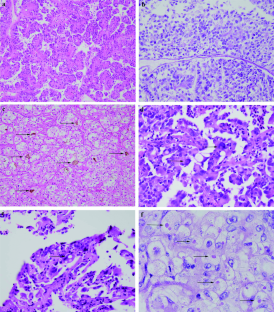 Xp11 translocation renal cell carcinoma and clear cell renal cell ...