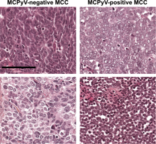Morphologic and immunophenotypical features distinguishing Merkel cell ...
