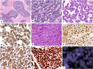 GLI1 -amplifications expand the spectrum of soft tissue neoplasms ...