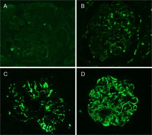 Utility of immunohistochemistry with C3d in C3 glomerulopathy | Modern ...