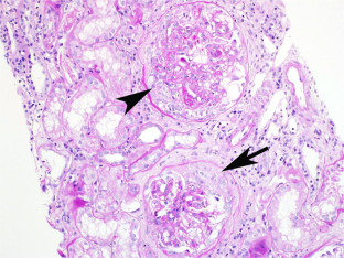 De novo pauci-immune glomerulonephritis in renal allografts | Modern ...