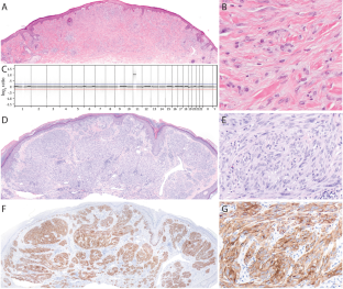 New and evolving concepts of melanocytic nevi and melanocytomas ...