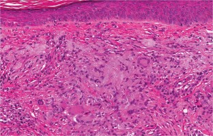 Common and critical inflammatory dermatoses every pathologist should ...