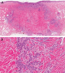 Common and critical inflammatory dermatoses every pathologist should know | Modern Pathology