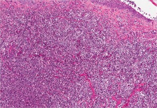 Common and critical inflammatory dermatoses every pathologist should ...