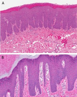 Common and critical inflammatory dermatoses every pathologist should ...