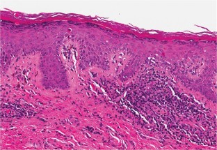 Common and critical inflammatory dermatoses every pathologist should know | Modern Pathology