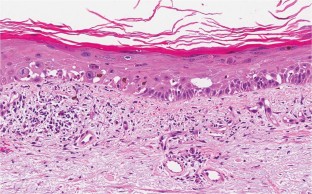 Common and critical inflammatory dermatoses every pathologist should ...