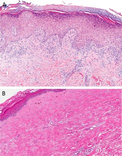 Common and critical inflammatory dermatoses every pathologist should know | Modern Pathology