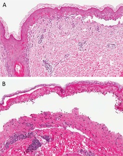 Common and critical inflammatory dermatoses every pathologist should know | Modern Pathology