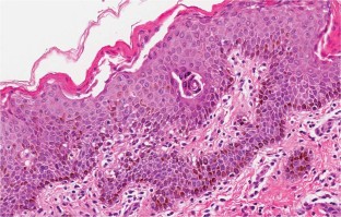 Common and critical inflammatory dermatoses every pathologist should know | Modern Pathology