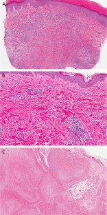 Common and critical inflammatory dermatoses every pathologist should know | Modern Pathology