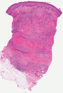 Common and critical inflammatory dermatoses every pathologist should ...