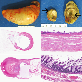 Post-inflammatory mucosal hyperplasia and appendiceal diverticula ...