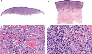 Spitz melanoma is a distinct subset of spitzoid melanoma | Modern Pathology