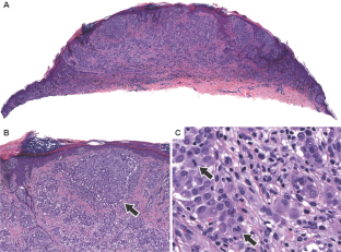 Spitz melanoma is a distinct subset of spitzoid melanoma | Modern Pathology