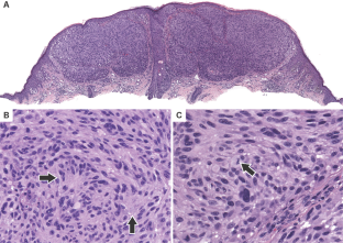 Spitz melanoma is a distinct subset of spitzoid melanoma | Modern Pathology