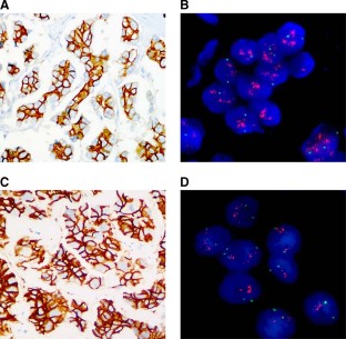 Intense basolateral membrane staining indicates HER2 positivity in ...