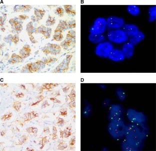 Intense basolateral membrane staining indicates HER2 positivity in ...