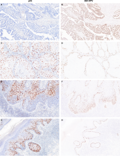 p53 Immunohistochemical patterns in HPV-related neoplasms of the female ...